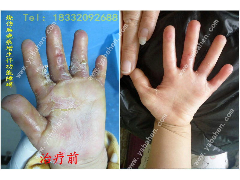 手指粘连图片手指肌腱粘连锻炼图手指粘连什么症状图片大山谷图库